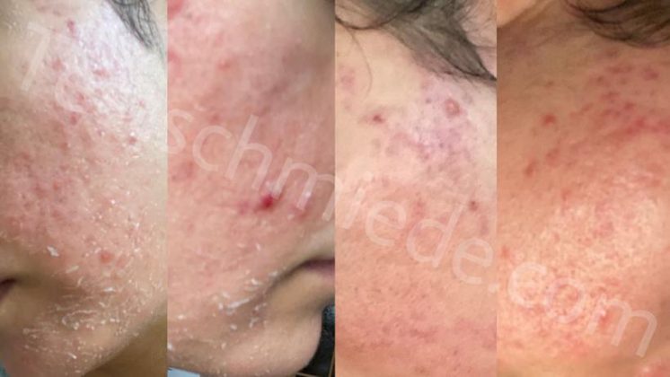 Selgamis im Test - 4 Monate Erfahrungen bei mittelschwerer Akne