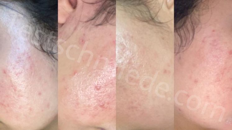 Selgamis im Test - 4 Monate Erfahrungen bei mittelschwerer Akne