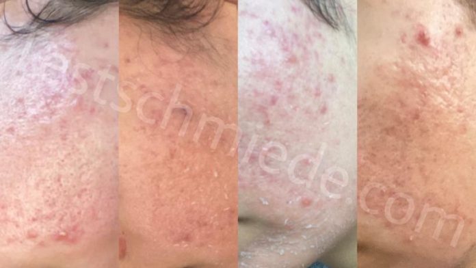 Selgamis im Test - 4 Monate Erfahrungen bei mittelschwerer Akne